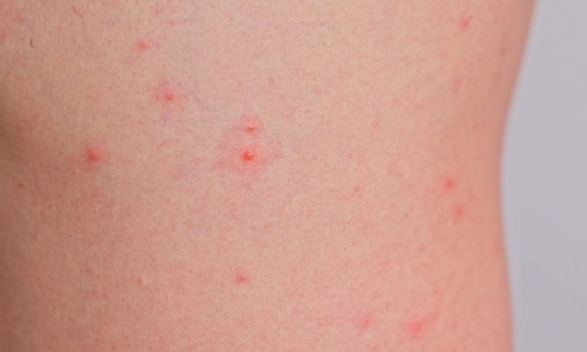 Crvene tačkice po telu - 6 najčešćih uzroka i kako ih lečiti